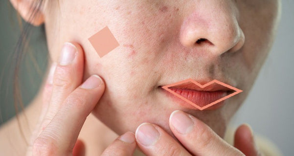 Summer Acne | Skin Society