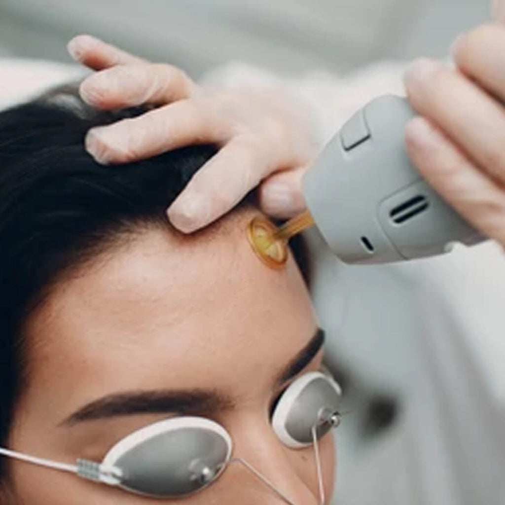 Laser Forehead Woman | Skin Society